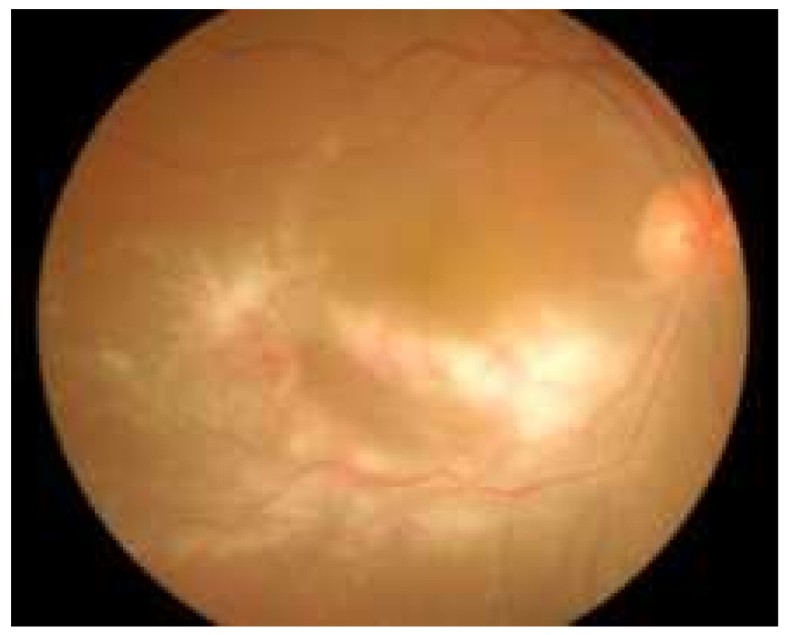 Frosted branch angiitis as a result of immune recovery uveitis in a ...