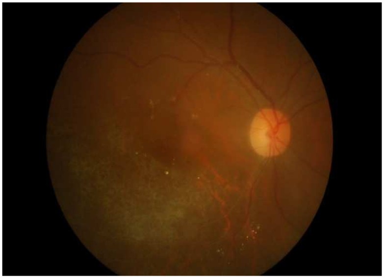 Frosted branch angiitis as a result of immune recovery uveitis in a ...