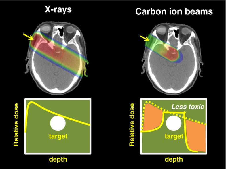 Particle radiotherapy with carbon ion beams | SpringerLink