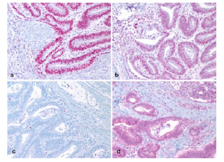 Atypical identification of Lynch syndrome by immunohistochemistry and ...