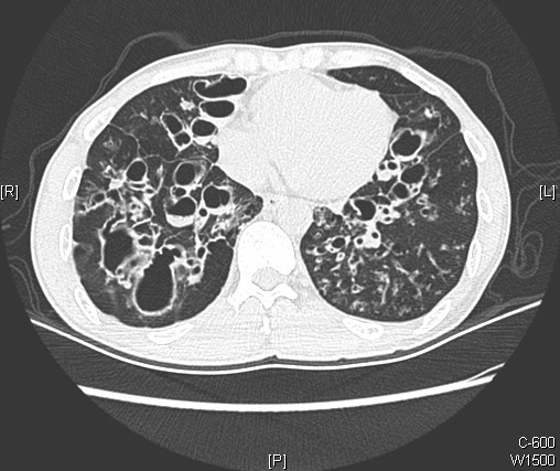 Haemophilus influenzae and the lung (Haemophilus and the lung ...