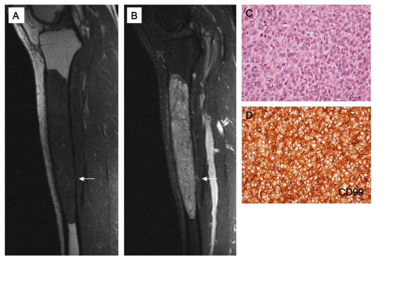 Localized Ewing sarcoma of the tibia | Clinical Sarcoma Research | Full ...