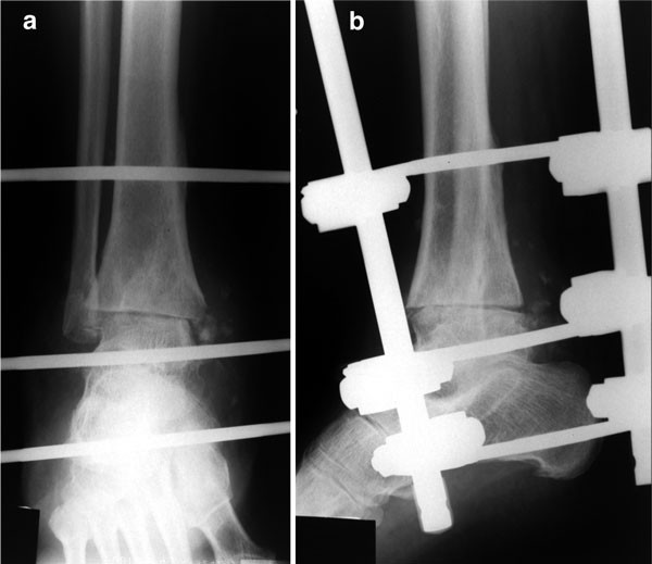 Clinical results of resection arthrodesis by triangular external ...