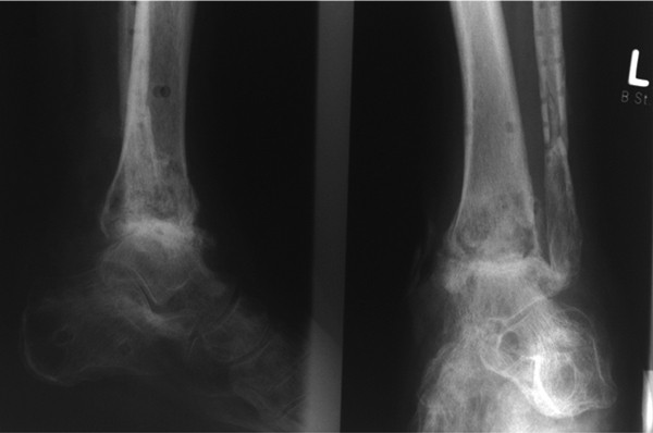 Posttraumatic severe infection of the ankle joint - long term results ...