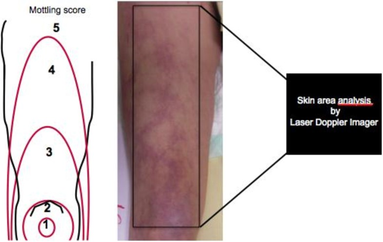 Alteration of skin perfusion in mottling area during septic shock ...