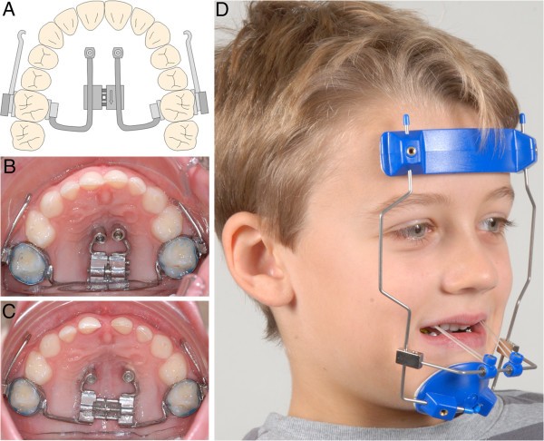 Maxillary protraction using a hybrid hyrax-facemask combination ...