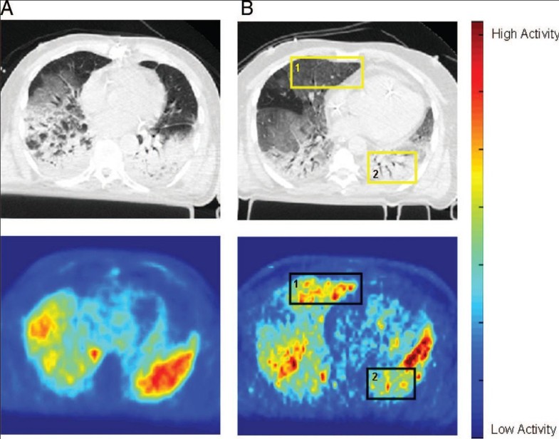 Clinical review: Lung imaging in acute respiratory distress syndrome ...