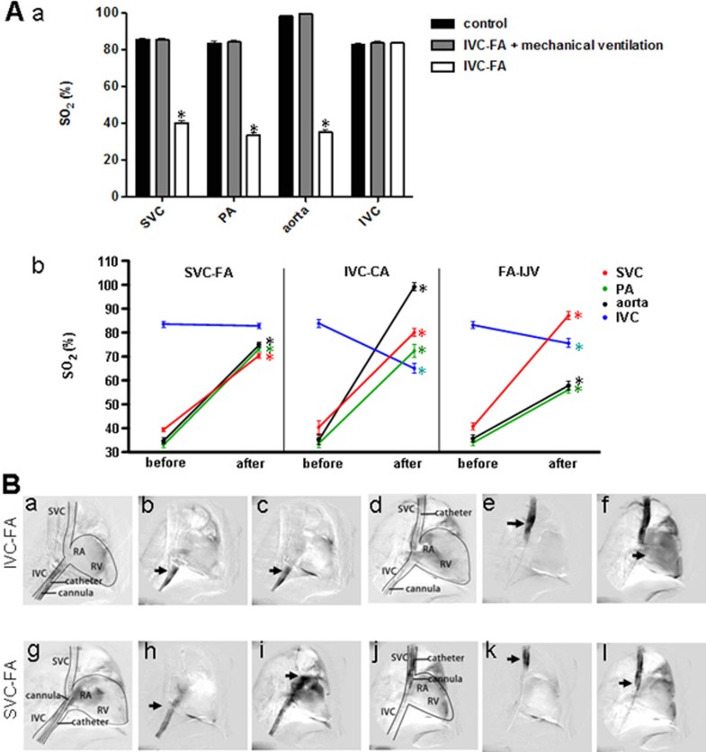 Differential venous oxygen return: a key factor of differential hypoxia ...