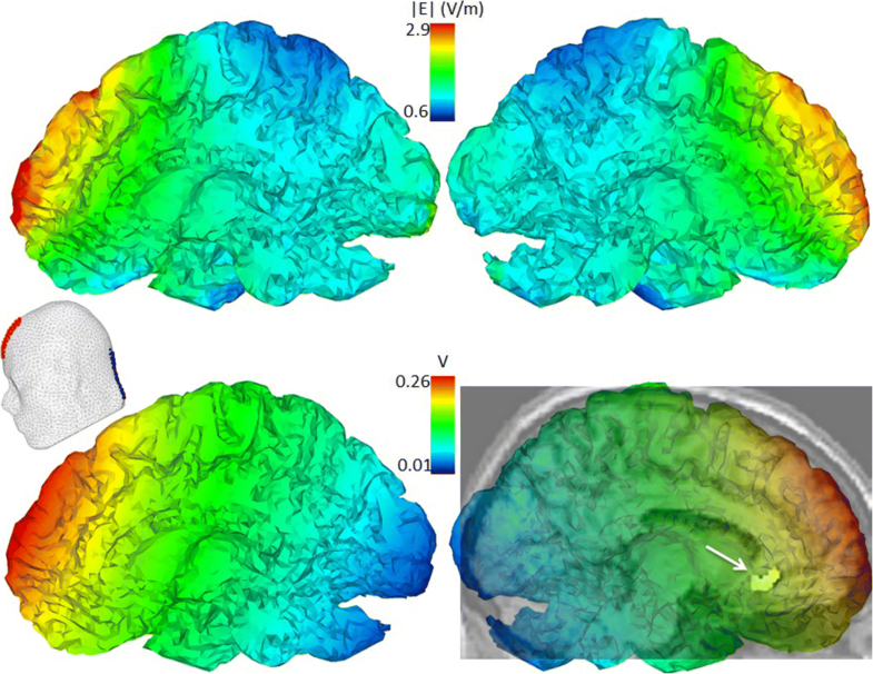 Anodal frontal tDCS for chronic cluster headache treatment: a proof-of ...