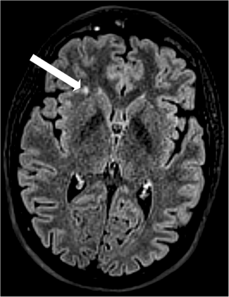 Influence of hemispheric white matter lesions and migraine ...