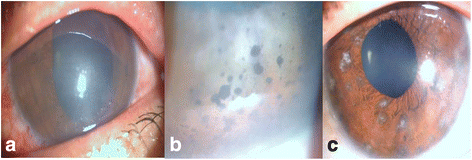 Ocular involvement associated with varicella in adults | Journal of ...