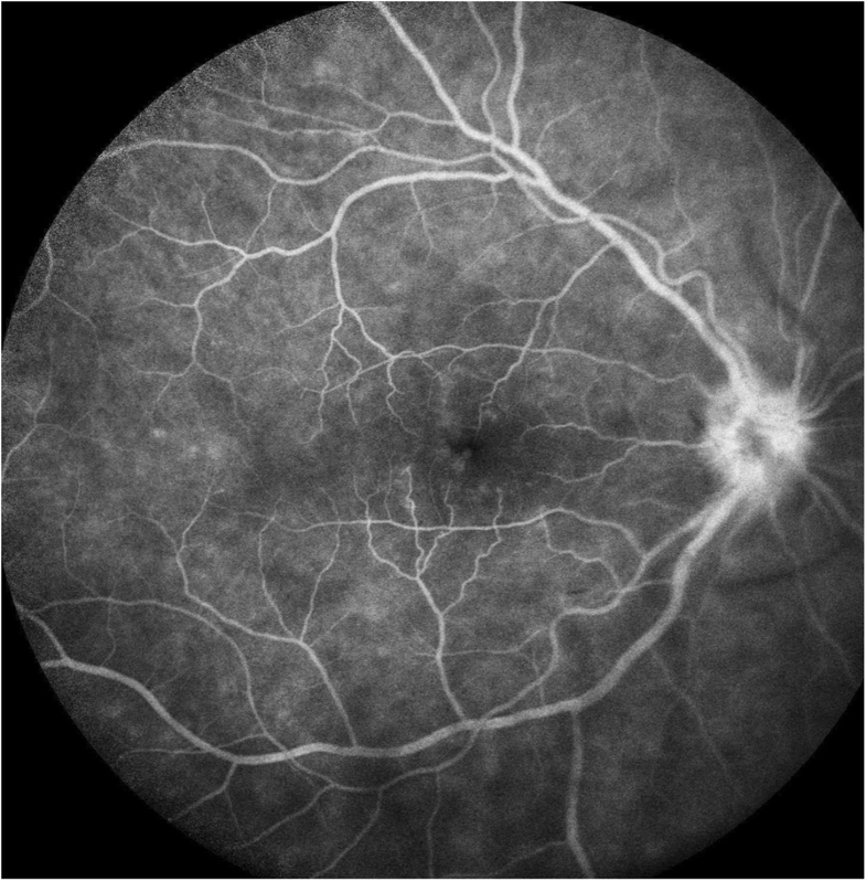 Necrotising retinopathy-like lesions as a manifestation of ocular ...