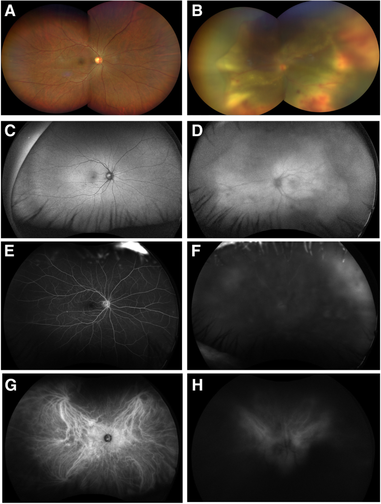 Vitreoretinal lymphoma followed by systemic diffuse large B cell ...