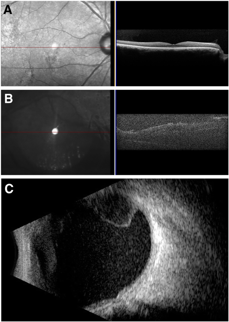 Vitreoretinal lymphoma followed by systemic diffuse large B cell ...