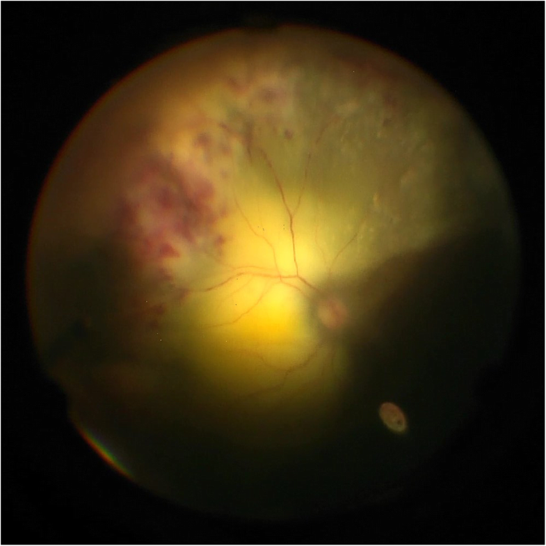 Vitreoretinal lymphoma followed by systemic diffuse large B cell ...