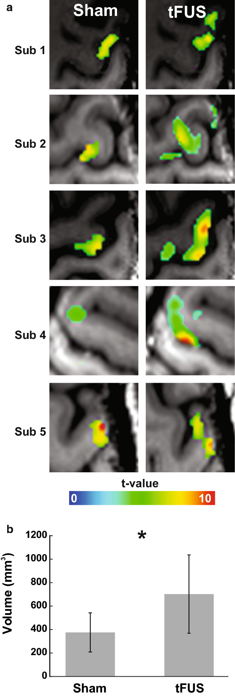 Effects of transcranial focused ultrasound on human primary motor ...
