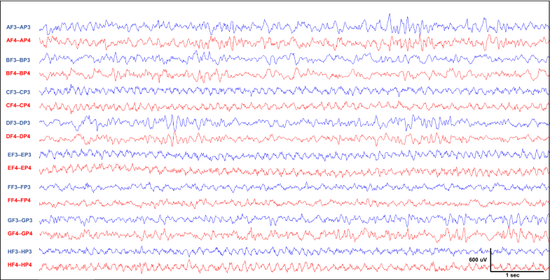 Enhanced setup for wired continuous long-term EEG monitoring in ...