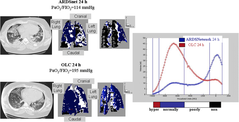 Effects of the open lung concept following ARDSnet ventilation in ...