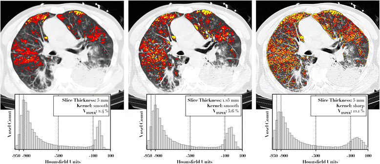 Lung hyperaeration assessment by computed tomography: correction of ...