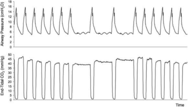 New Generation Continuous Cardiac Output Monitoring From Carbon Dioxide