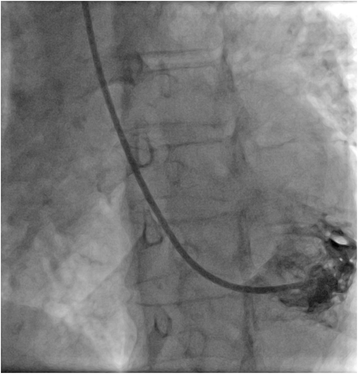 Postprocedural radial artery occlusion rate using a sheathless guiding ...