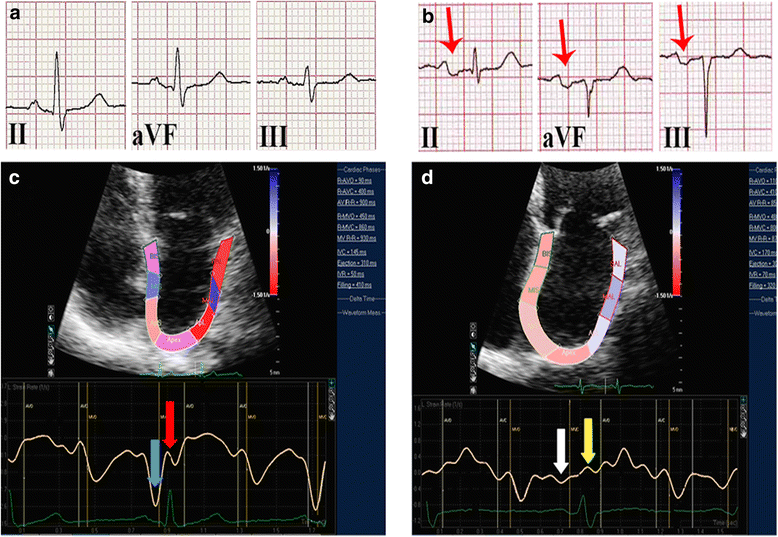 Interatrial block and atrial remodeling assessed using speckle tracking ...