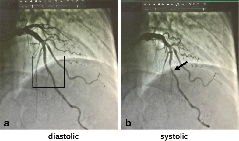 A potential protective element of myocardial bridge against severe ...