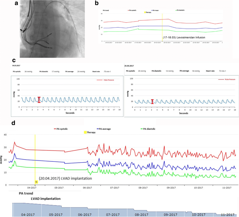 The CardioMEMS system in the clinical management of end-stage heart ...