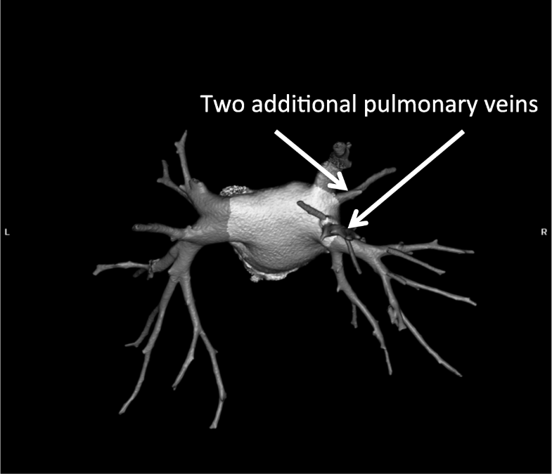 Pulmonary vein anatomy variants as a biomarker of atrial fibrillation ...