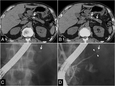 Extracorporeal shock wave lithotripsy treatment of pancreatic stones ...