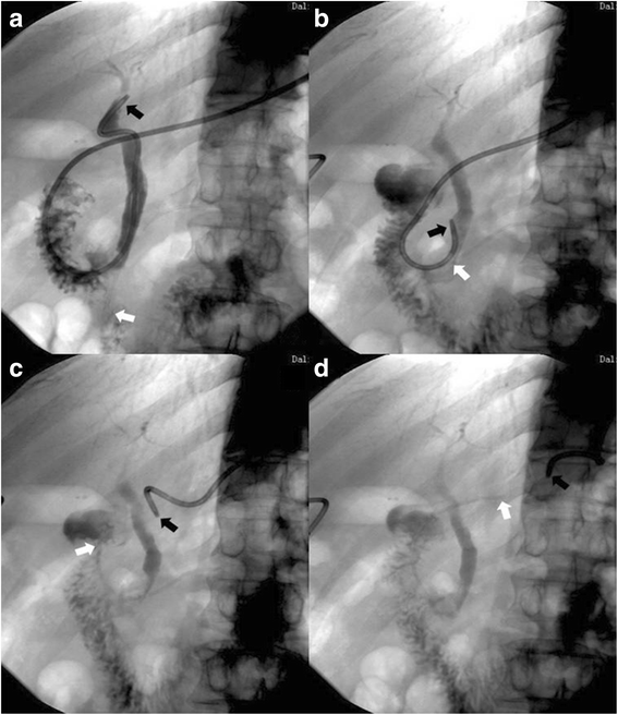 The modified pancreatic stent system for prevention of post-ERCP ...