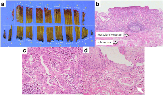 Treatment of long-segment Barrett’s adenocarcinoma by complete circular ...