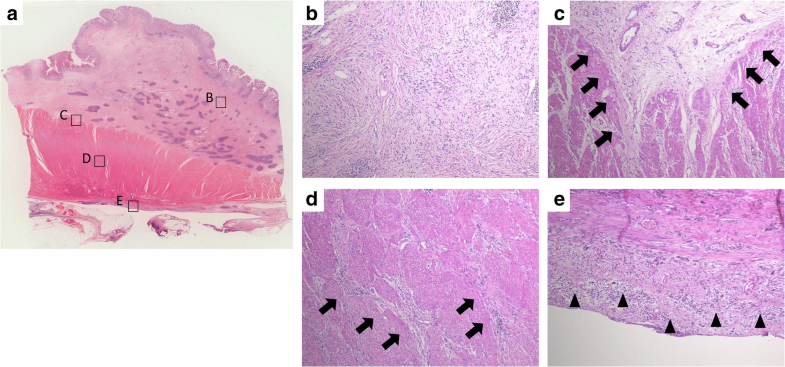 Invasive inflammatory fibroid polyp of the stomach: a case report and ...