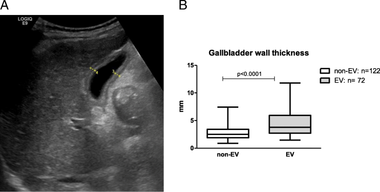 Gall bladder wall thickening as non-invasive screening parameter for ...