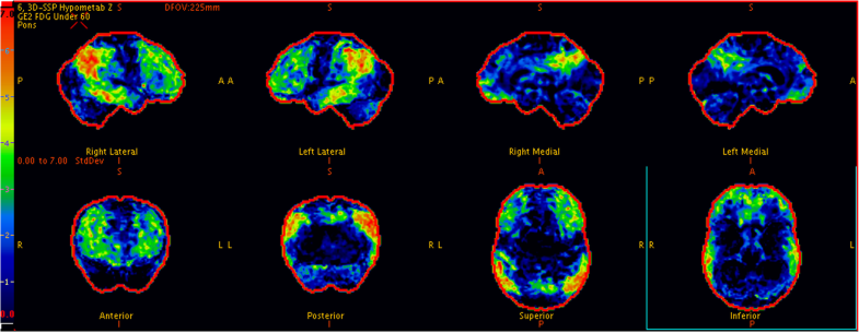 FDG-PET in suspected dementia with Lewy bodies: a case report | BMC ...