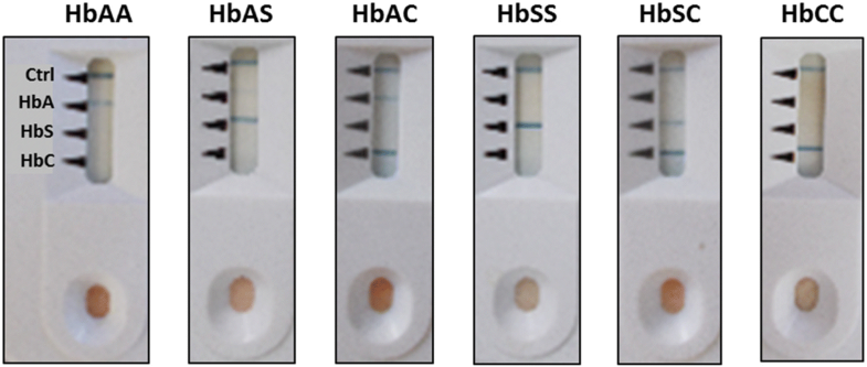 Diagnostic accuracy in field conditions of the sickle SCAN® rapid test ...