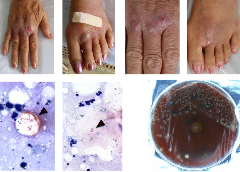 Mycobacterium fortuitum skin infections after subcutaneous injections ...