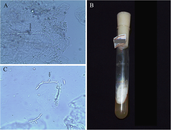 An ultrastructural study of Trichophyton rubrum induced onychomycosis ...