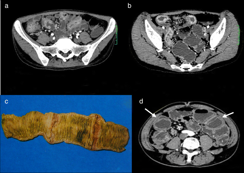 Evaluation of intestinal tuberculosis by multi-slice computed ...