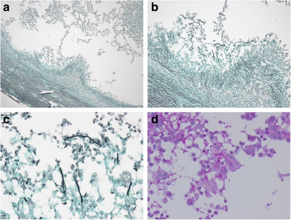 Dermatophyte abscesses caused by Trichophyton rubrum in a patient ...