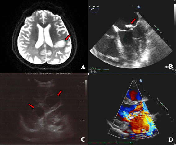 Multiple systemic embolism in infective endocarditis underlying in ...