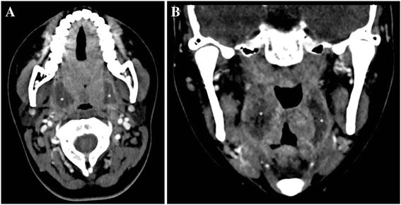 Impact of anti-inflammatory drug consumption in peritonsillar abscesses ...
