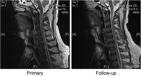 Acute transverse myelitis of the cervical spine secondary to psoas abscess | BMC Infectious ...