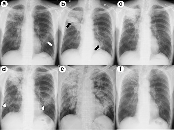 Natural history of Mycobacterium fortuitum pulmonary infection ...