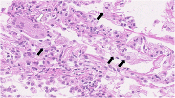 Natural history of Mycobacterium fortuitum pulmonary infection ...