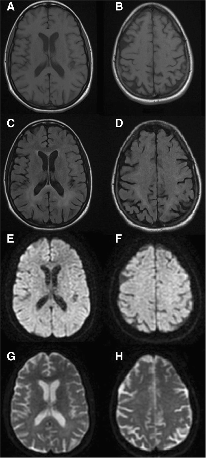 Mononeuritis multiplex: an uncommon neurological manifestation of ...