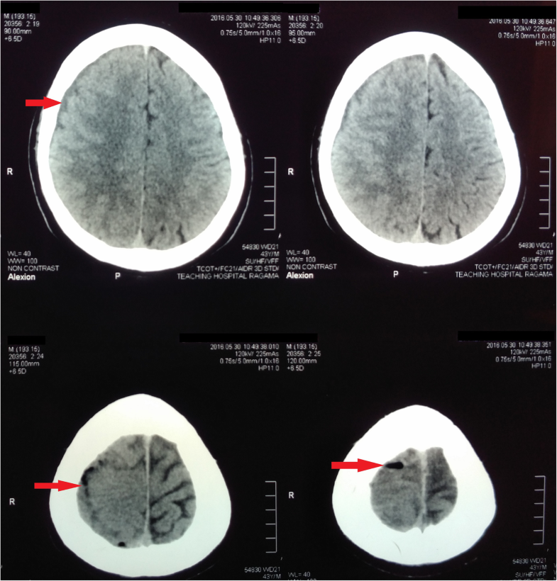 Melioidosis with a subdural collection – a case report | BMC Infectious ...
