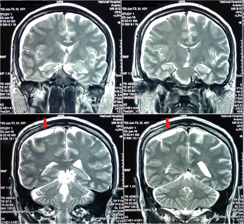 Melioidosis with a subdural collection – a case report | BMC Infectious ...
