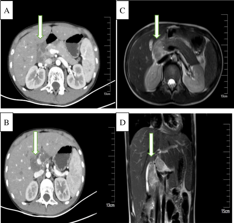 Hepatic hilar mass in an adolescent: a rare case of hepatobiliary ...