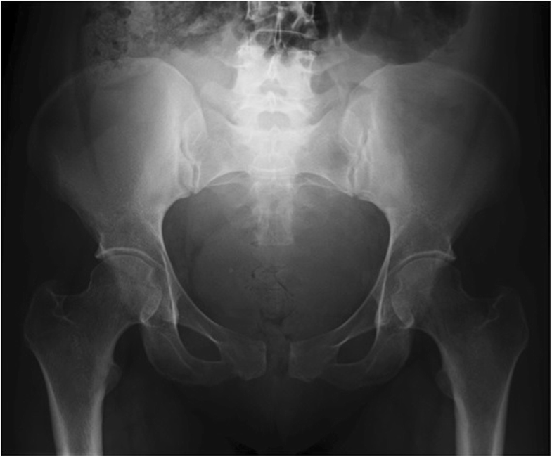 Osteomyelitis of the pubic symphysis caused by methicillin-resistant ...